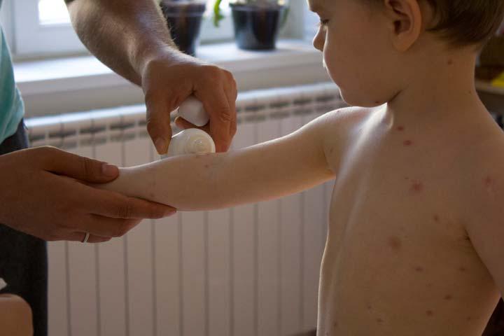 Symptoms Of Smallpox In Children And Treatment Options