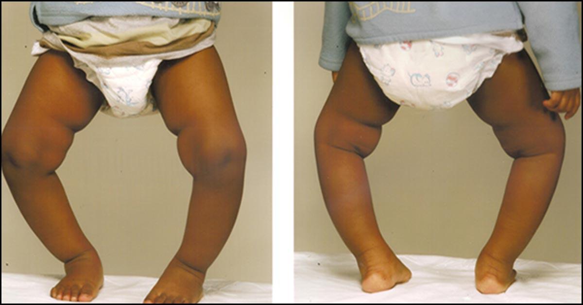 What Are Bowed Legs In Babies Causes And Treatment