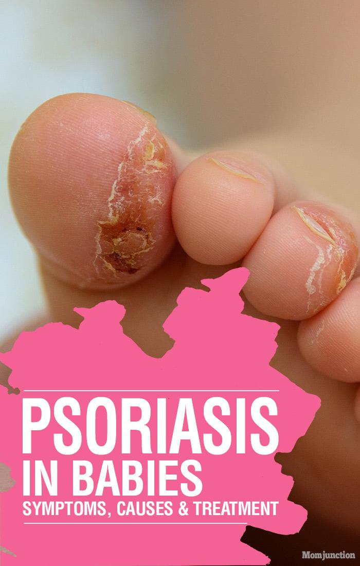Psoriasis In Babies: Symptoms, Causes & Treatment You Should Know