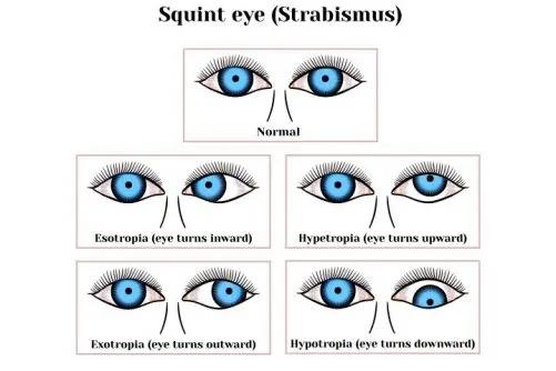 Strabismus In Infants: Symptoms, Causes, Diagnosis And Risks