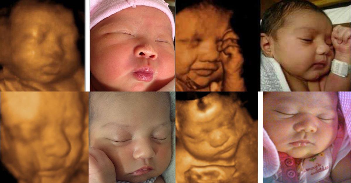 3D Ultrasound During Pregnancy When It Is Done How Safe It Is