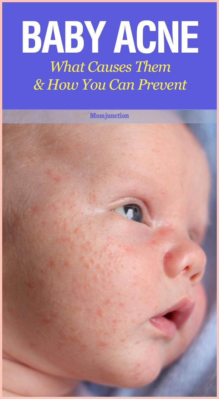 Baby Acne: What Causes Them And How You Can Prevent