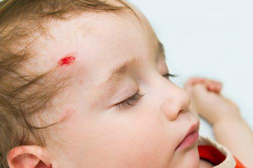 10 Signs Of Concussion In Babies And Ways To Treat It