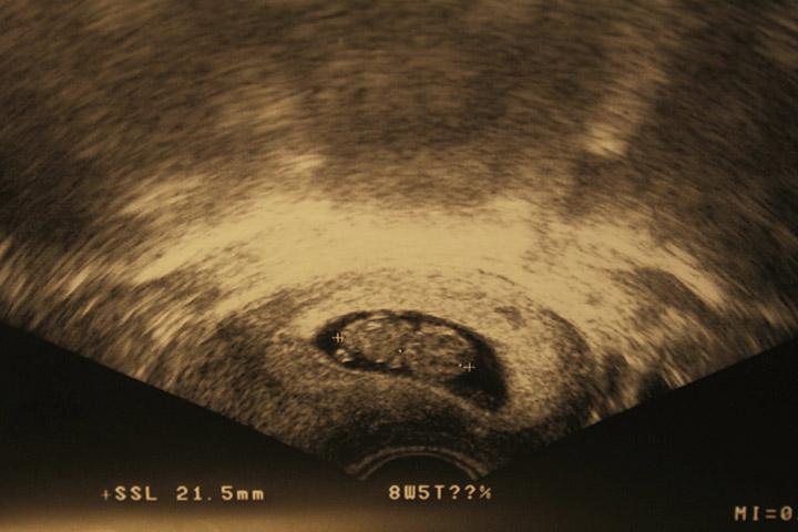 8th Week Ultrasound: Baby Development, Abnormalities And More