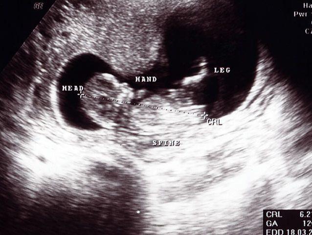 Crown Rump Length Chart And Measurement