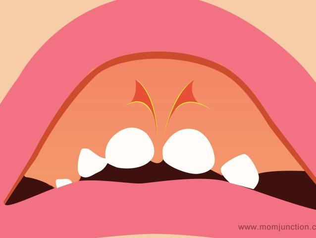 Lip Tie In Babies: Causes, Symptoms & Treatment