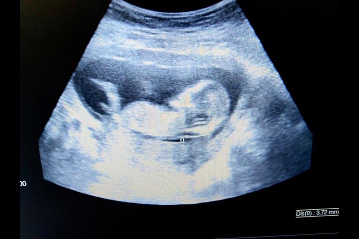 Nuchal Translucency Scan: What It Is & How It Is Done