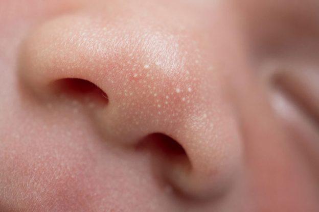 White Spots On A Child's Face: Causes, Remedies & Treatment