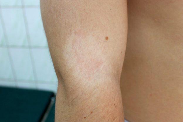 White Spots On A Child's Face: Causes, Remedies & Treatment