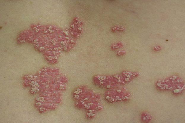 Psoriasis in Children: Types, Causes, Symptoms, And Treatment