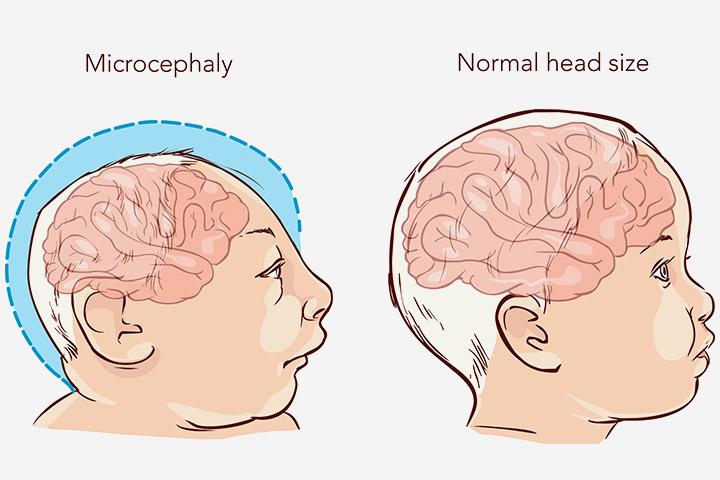 Microcephaly In Babies: Causes, Symptoms And Treatment - Parenting Boss
