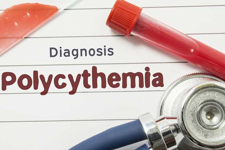 Neonatal Polycythemia: Causes, Symptoms And Treatment - Parenting Boss