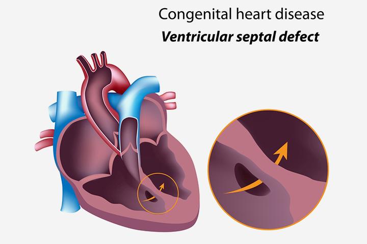 6 Types Of Congenital Heart Disease In Children & Treatment ...