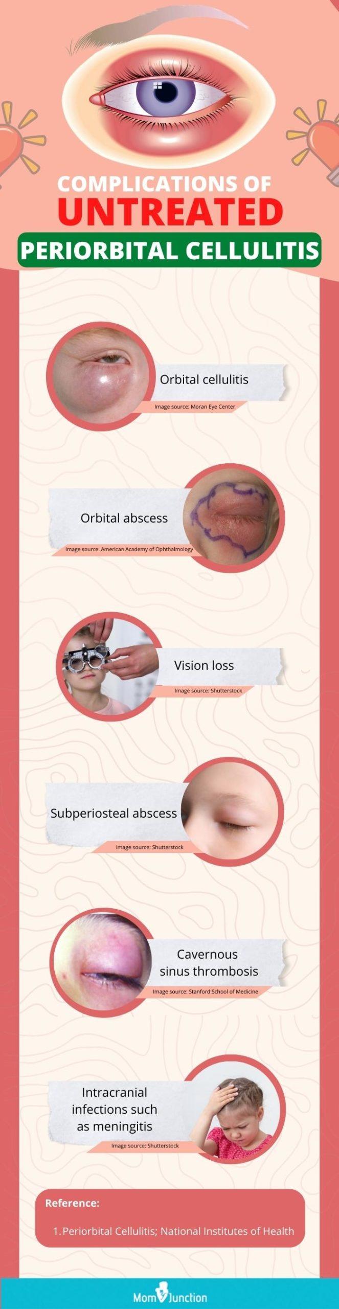 Symptoms And Causes Of Periorbital Cellulitis In Children Symptoms And Causes Of Periorbital Cellulitis In Children